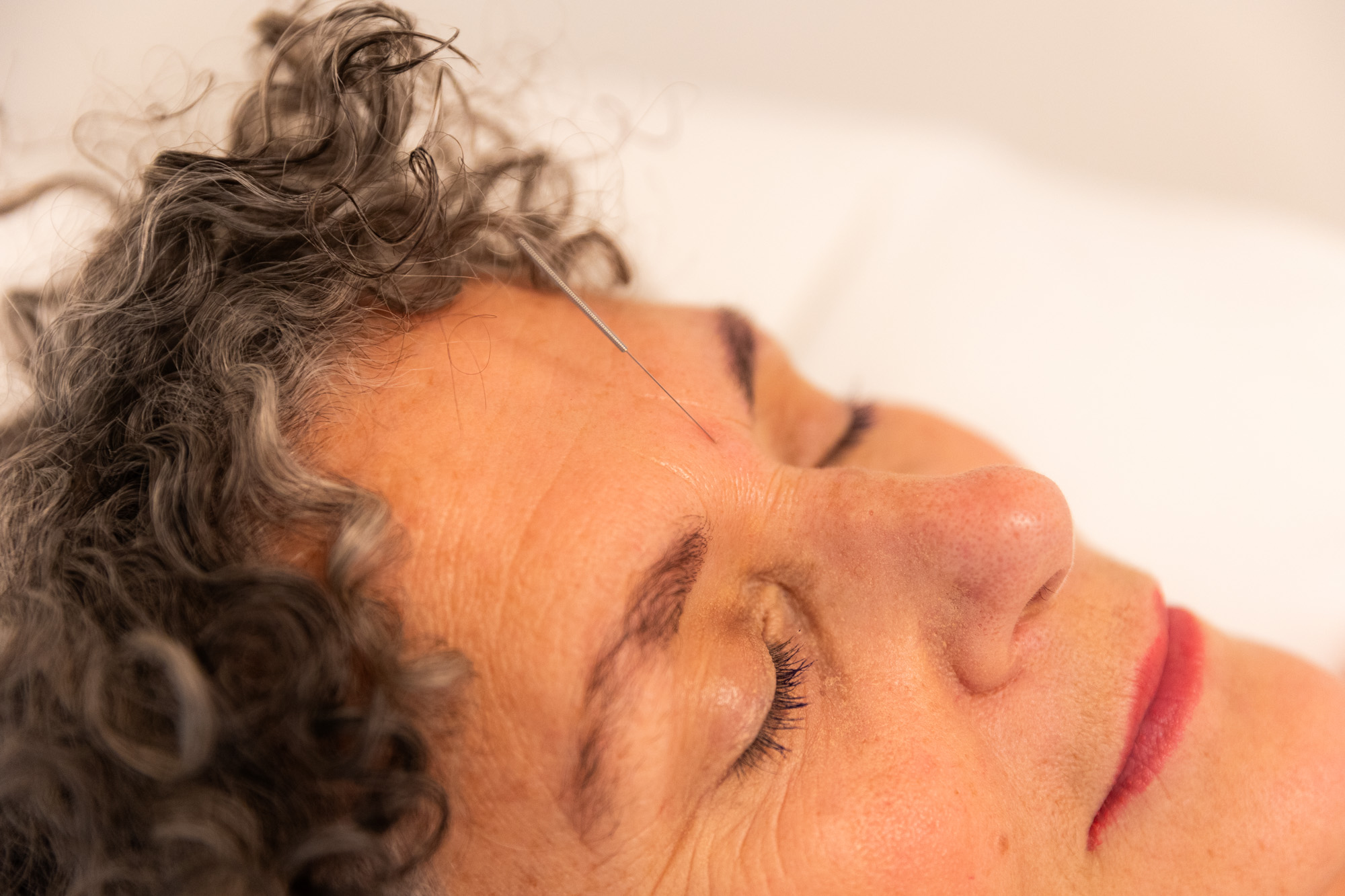 Acupuncture in Seattle | Village Medicine